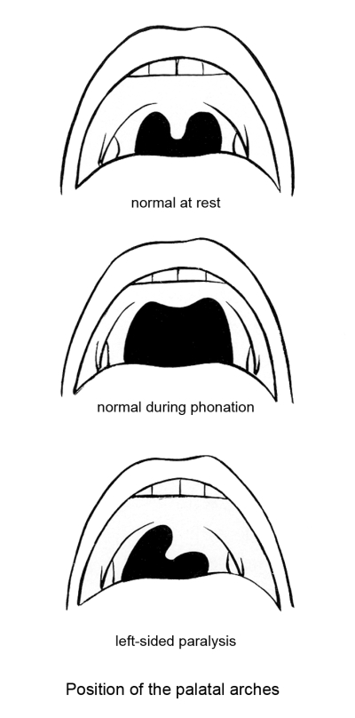 The cranial nerves - CN IX, X - Qpercom | Skills in Medicine