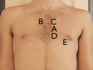 Auscultation points - Qpercom | Skills in Medicine