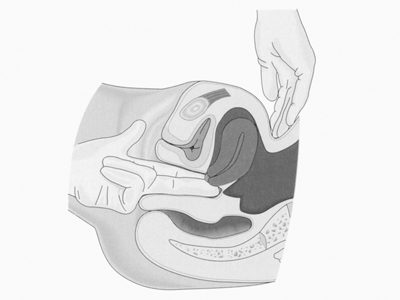 Bimanual examination - Qpercom | Skills in Medicine