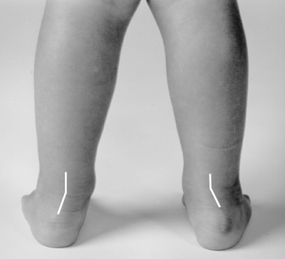 The Child With Genu Valgum Or Genu Varum - Qpercom | Skills in Medicine